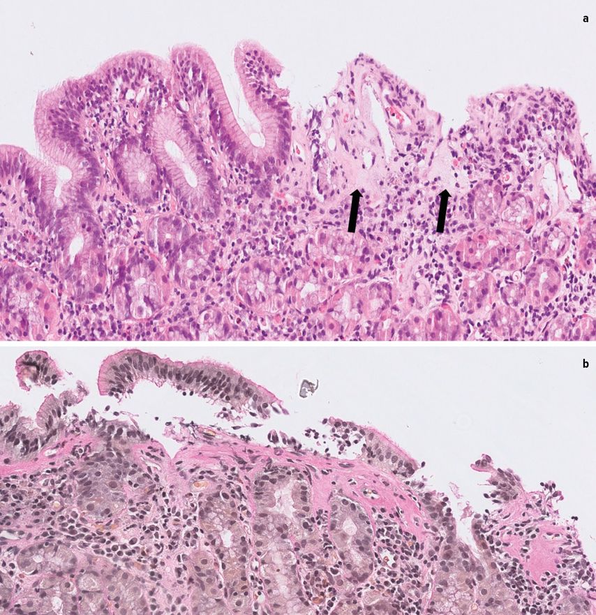 La gastrite collagène – une forme rare de gastrite - Médecine interne - Universimed - Medizin im ...